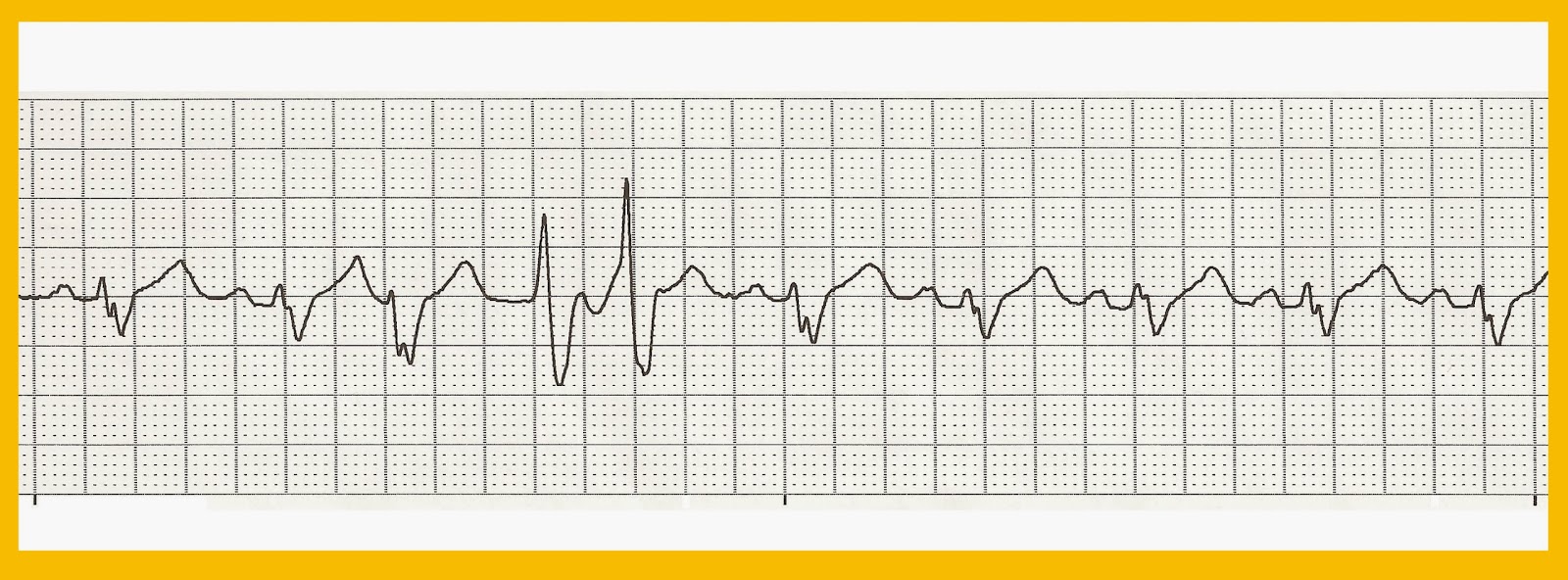 EKG Rhythm Strip Quiz 211