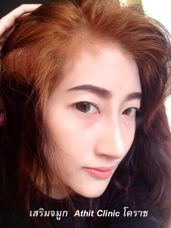 Athit คลินิก โคราช เสริมจมูก คาง ปากกระจับ ตาสองชั้น ลักยิ้ม ร้อยไหม โบท็อก หน้าเรียว ฉีดผิวขาว ...