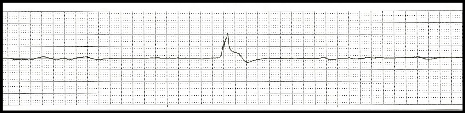EKG Rhythm Strips 91 Various Agonal Rhythms