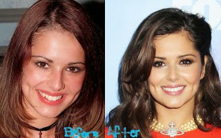 Cheryl Cole Plastic Surgery Before and After Botox Injection, Nose Job ...