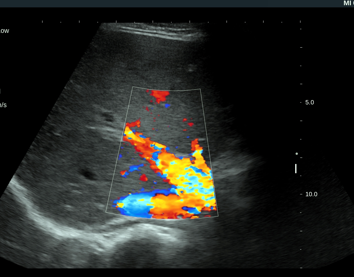 VIETNAMESE MEDIC ULTRASOUND: CASE 407: LIVER INFARCTION, Dr PHAN THANH ...