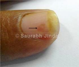Teledermatology for PG entrance: Alopecia Areata