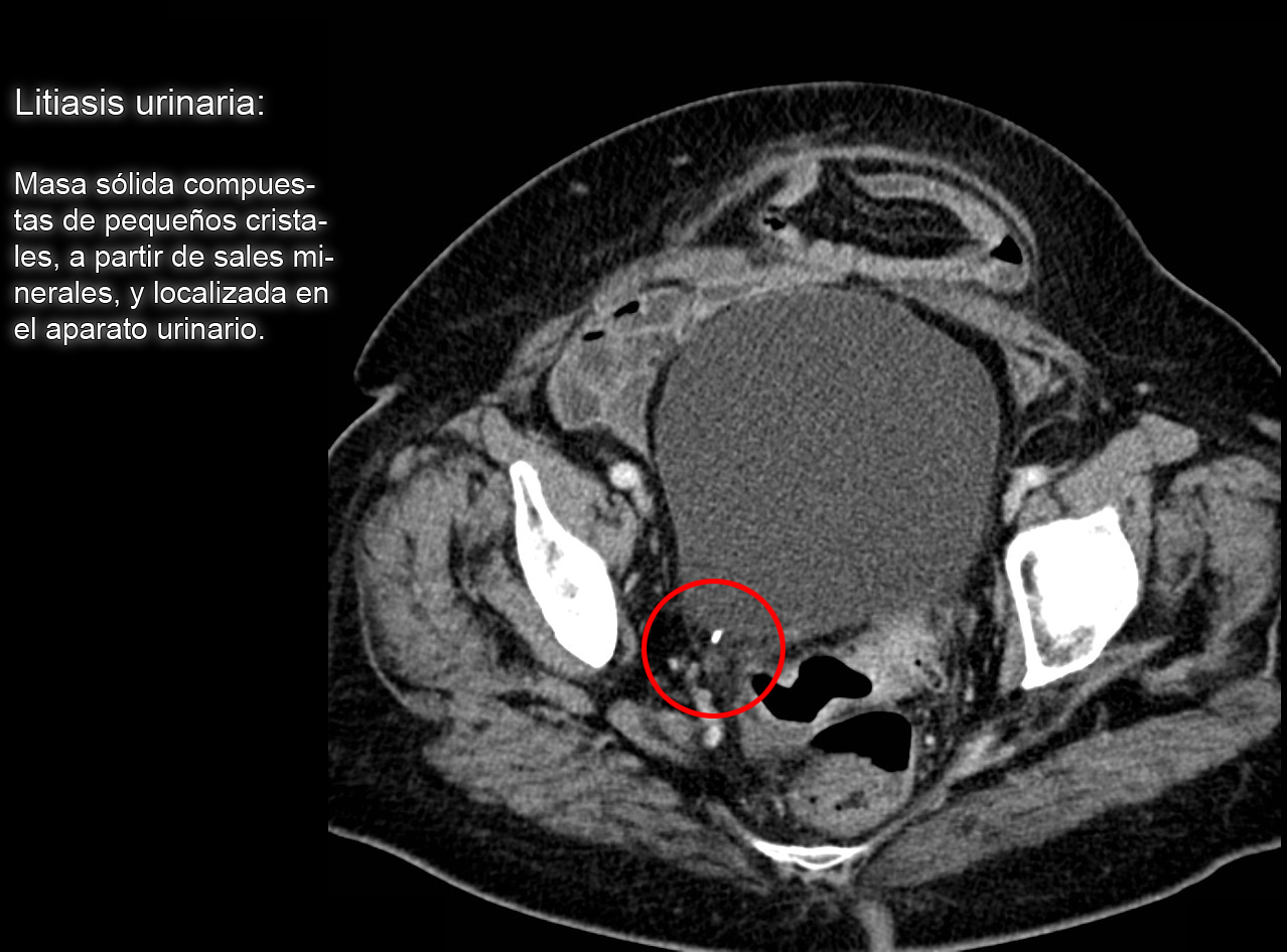 Tomografía Computada para estudiantes.: Litiasis Urinaria.