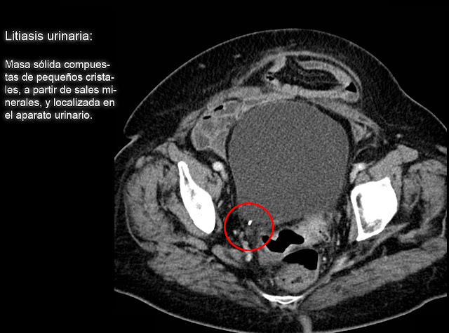 Tomografía Computada para estudiantes.: Litiasis Urinaria.