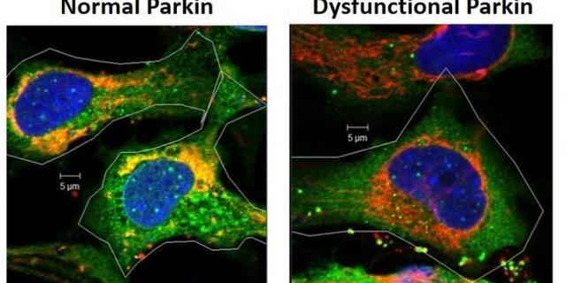 Our Parkinson's Place: Role of Parkin Gene in Eye Lens Free Radical ...