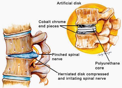 Medical Laws And Informations: Bulging Disc Treatment