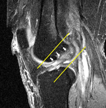 Radiology Channel: Anatomy of bundles of ACL and PCL.