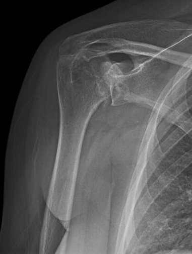 UW Shoulder and Elbow Academy: Addressing glenoid retroversion in total ...