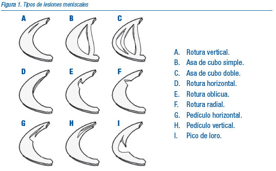 Fisioterapia: Lesiones de Meniscos