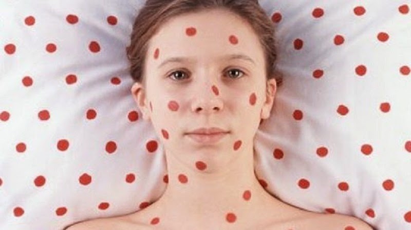 LA ROSOLIA (The rubella)﻿ - Blog di pociopocio