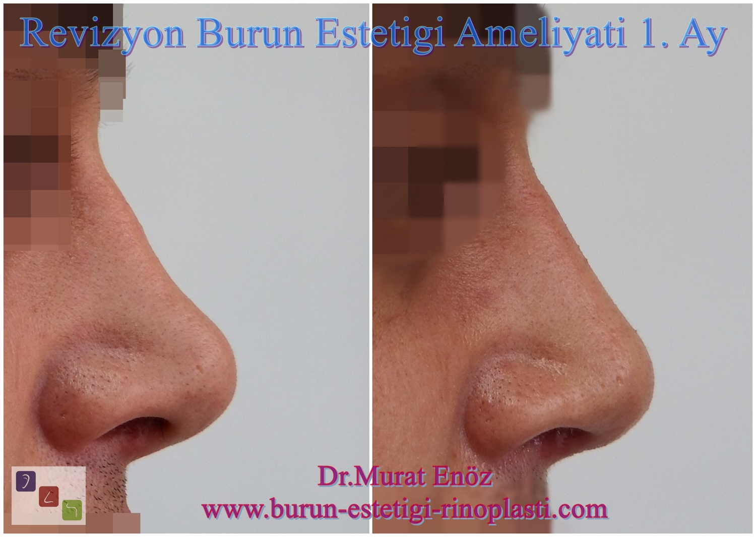 Augmentation Rhinoplasty With Pediatric Vascular Graft - Nose ...