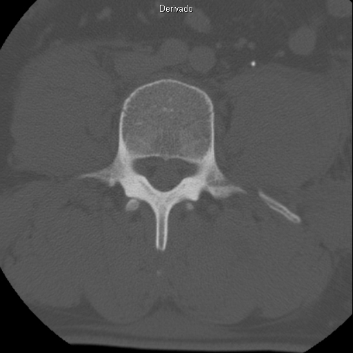 X-RAYview: Traumatismo da COLUNA LOMBAR
