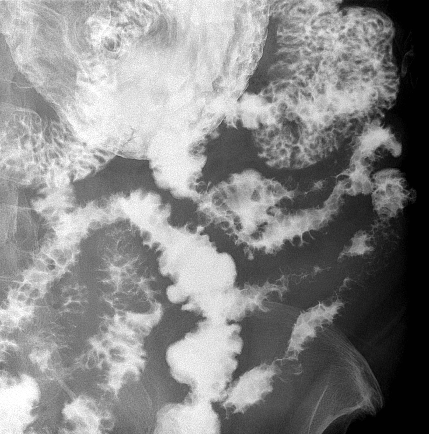 the xray doctor: xrayoftheweek 50: a classic barium appearance