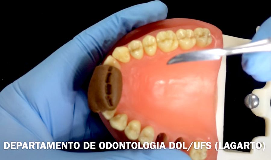 OCLUSÃO: Confecção de Jig de Lúcia com massa de modelar