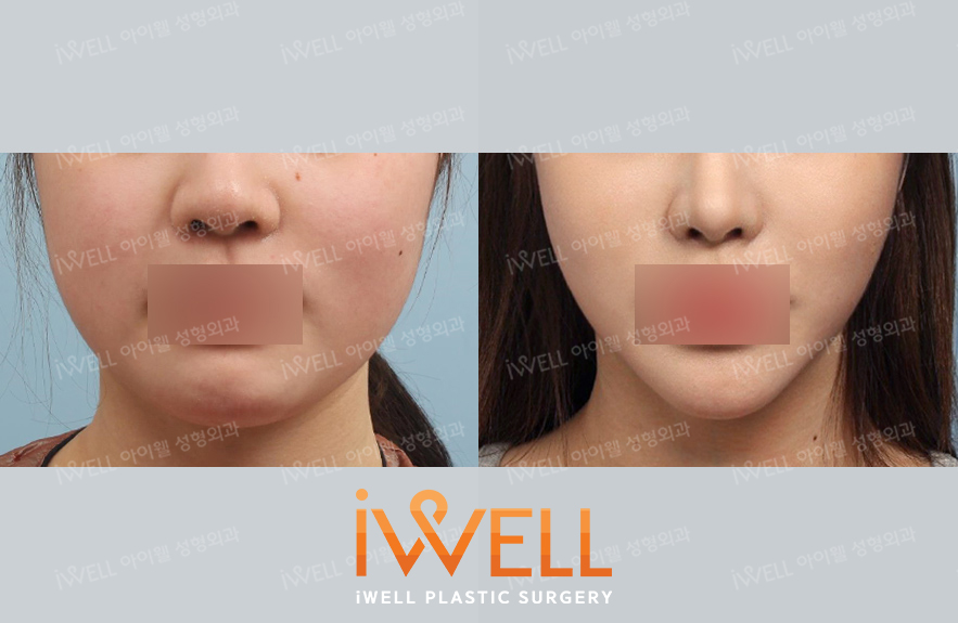 THE FACIAL BONE CONTOURING SURGERY - Long Curved Square Jaw. - iWELL ...