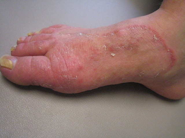 Enfermedades infecciosas por hongos | Eliminar infecciones por hongos