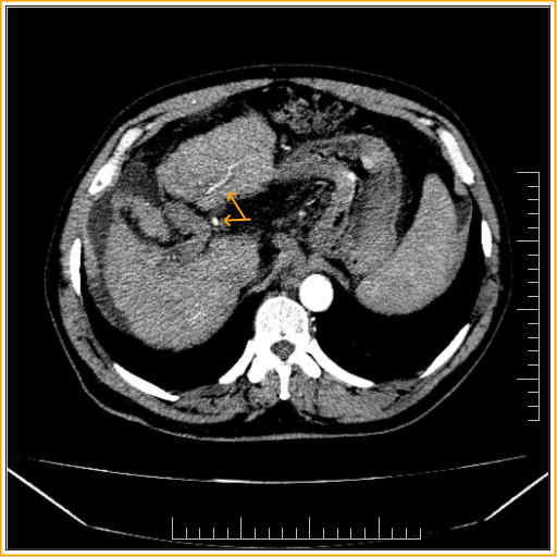 Hepatocellular carcinoma-CT - Sumer's Radiology Blog