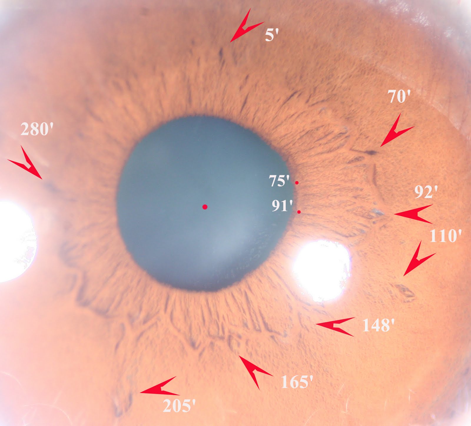 Modern & Multidimensional Iridology: Pupil & Collarette Analysis ...