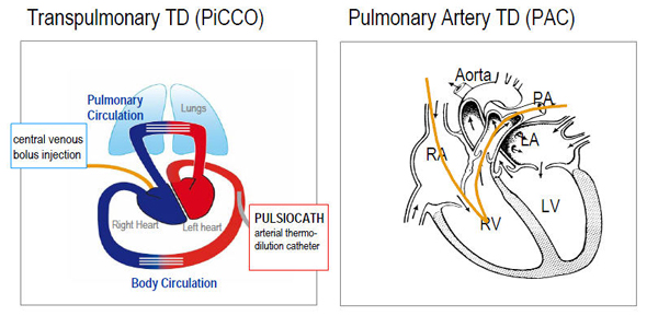 Diary of a future nurse: ICU: Termodilución Arterial Transpulmonar ...