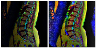 Nevit's blog: Color MRI of the Lumbar spine tonemapped.