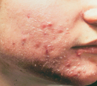 newallthing: Information Of Acne