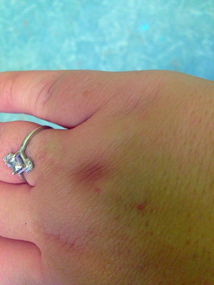 Heroin Track Marks On Hands