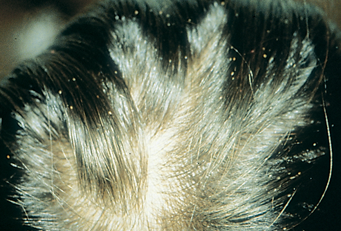 Hasil Gigitan Tungau - Kenali Ciri-ciri Gigitan 4 Serangga Ini pada ...