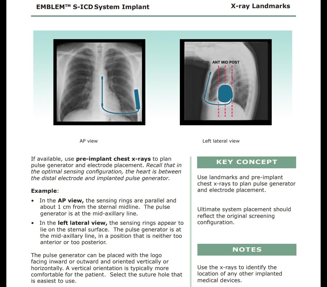 CVT Mohd Farid: Implant Management Of Subcutaneous ICD Boston Emblem SICD