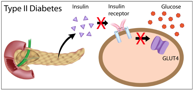 Great-West Life: Group Benefits: In everyday language, what is diabetes?