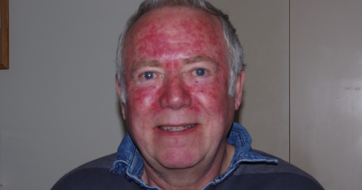 Alan's Efudix/Efudex Experience