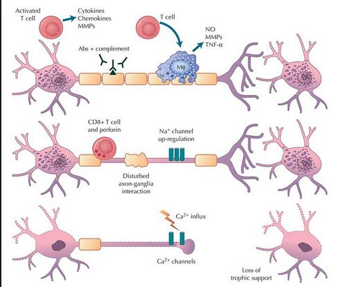 Axonal degeneration Of Neuron |Genetic Engineering Info
