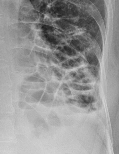 Chest Medicine Made Easy-Dr Deepu: The Rings !!!The Trams!!!, Chest X ...