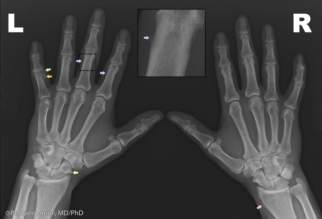 Roentgen Ray Reader: Diffuse Idiopathic Skeletal Hyperostosis: Hands