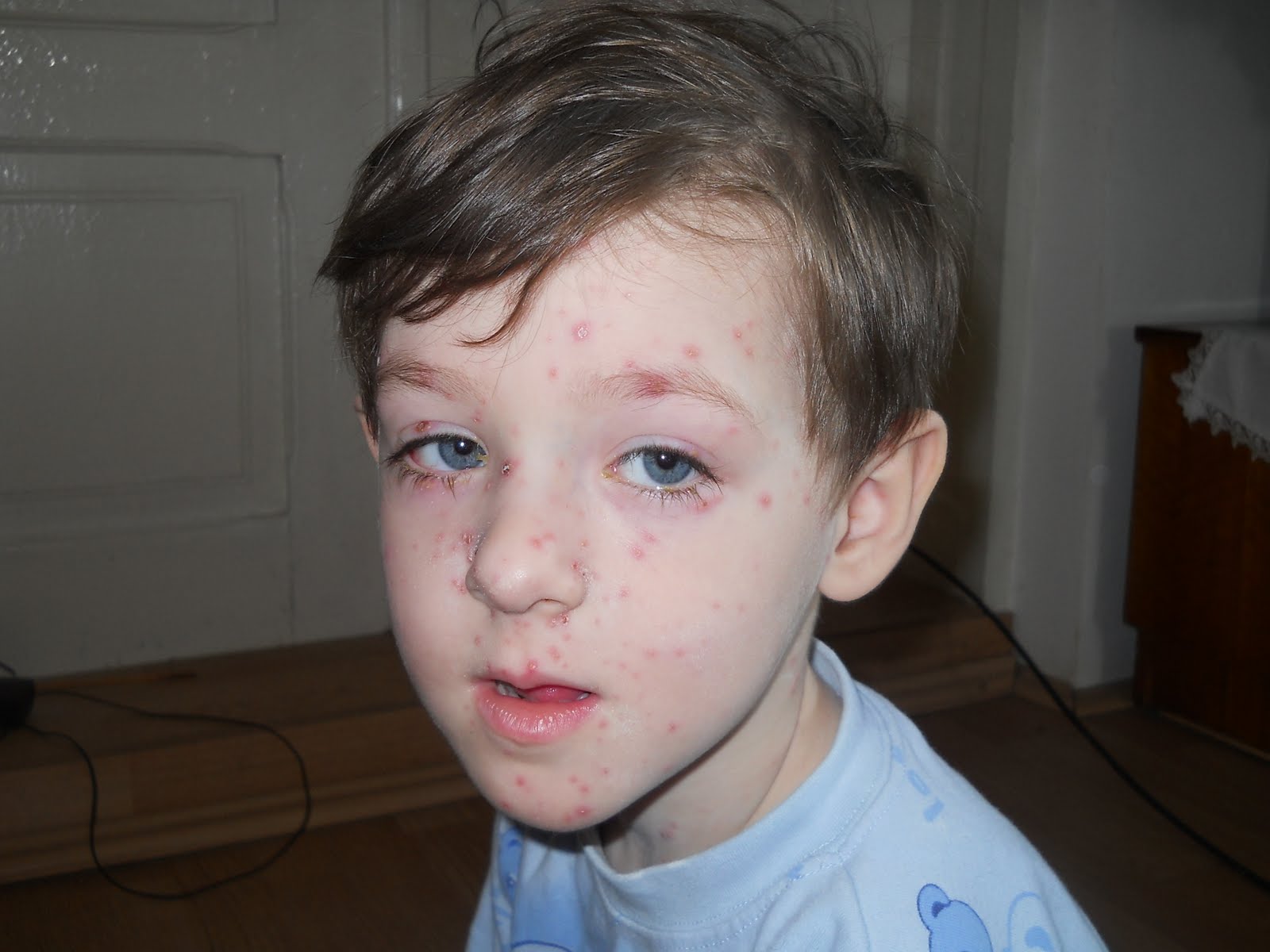 Jurnalul copilariei: Miliarde de bubite