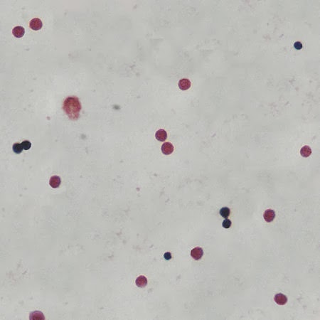 Medical Laboratory and Biomedical Science: CSF Gram Stain Case