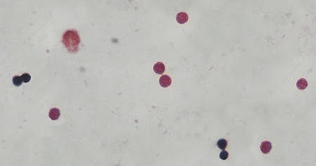 Medical Laboratory and Biomedical Science: CSF Gram Stain Case