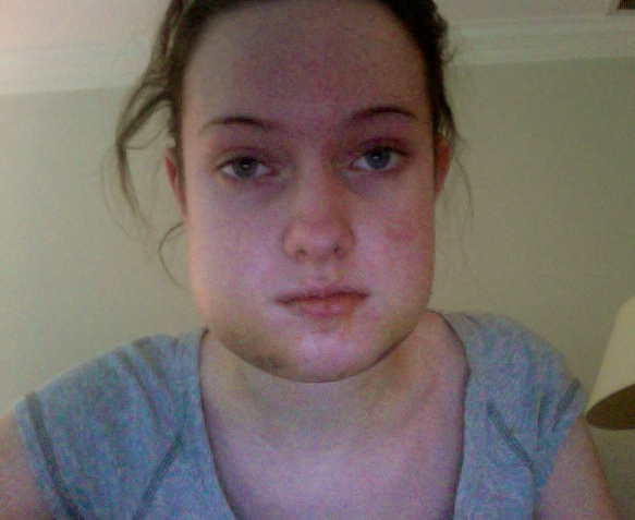 My Jaw Surgery Experience