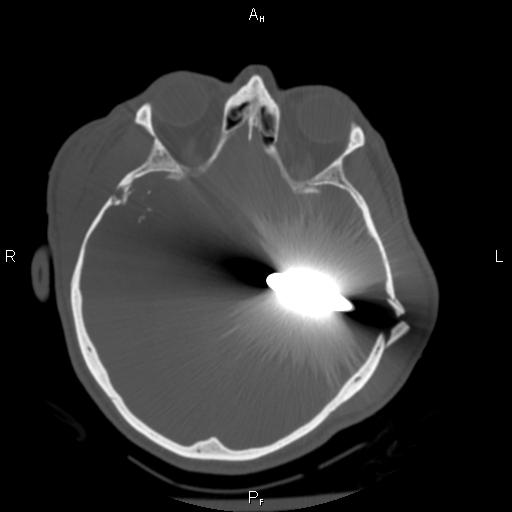 Post Gad: Nail Gun accident..