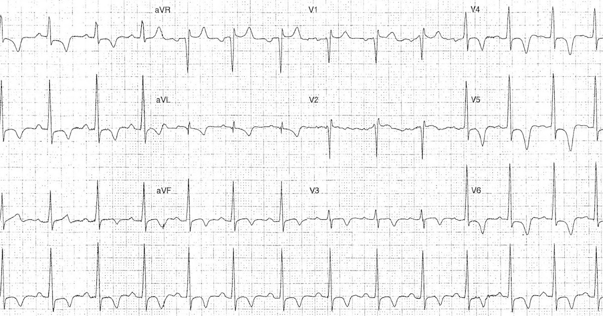 ECG of the Week: ECG of the Week - 12th September 2016 - Interpretation