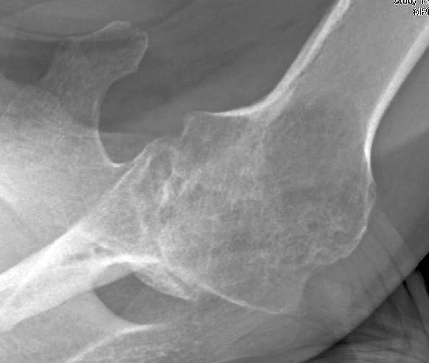 UW Shoulder and Elbow Academy: Shoulder joint replacement - many ...