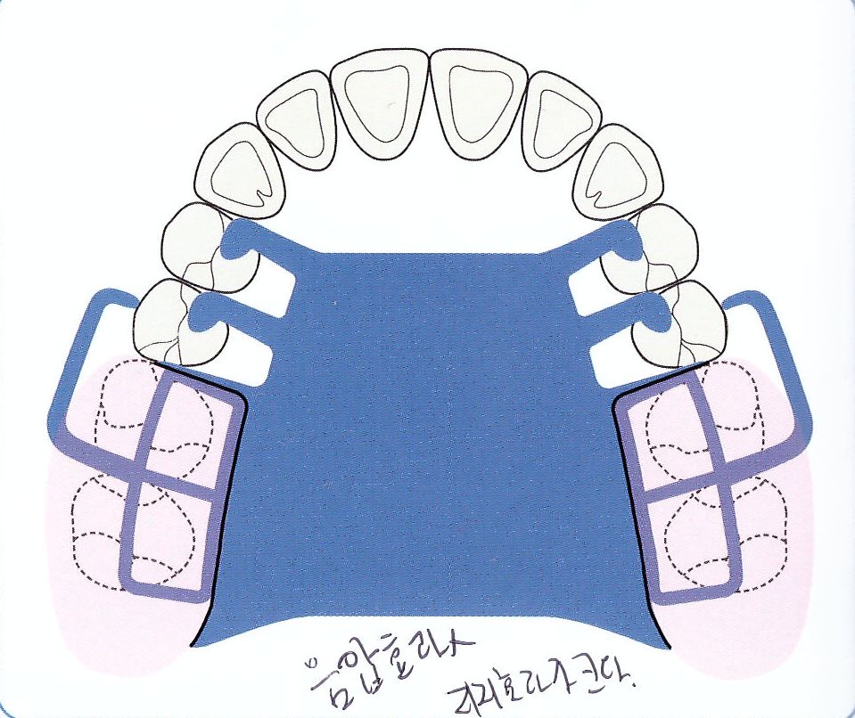 RPD 부분틀니 디자인 kennedy class 1 후방연장 국소의치 ~ Healthy Happy