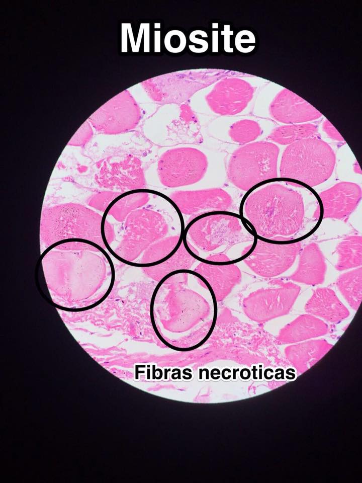 HISTOLOGIA90: MIOSITE