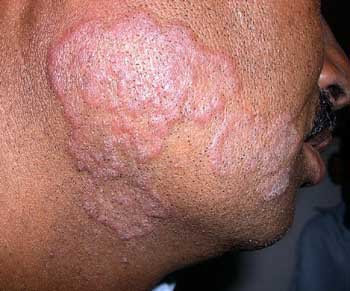 Health Importance for all people: Ringworm Treatment