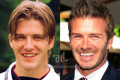 David Beckham Plastic Surgery Before and After Botox Injections Photos ...