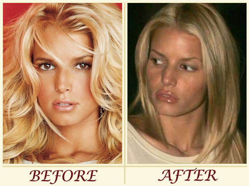 The teach Zone: Jessica Simpson Plastic Surgery before And After