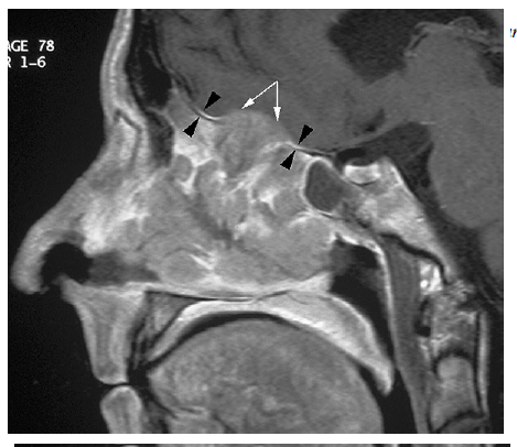 ESPE 203-2013: Imagenología de los senos paranasales en TC Y RM
