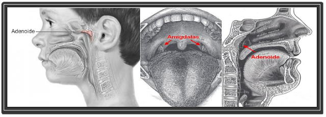 Adenoide o que é?