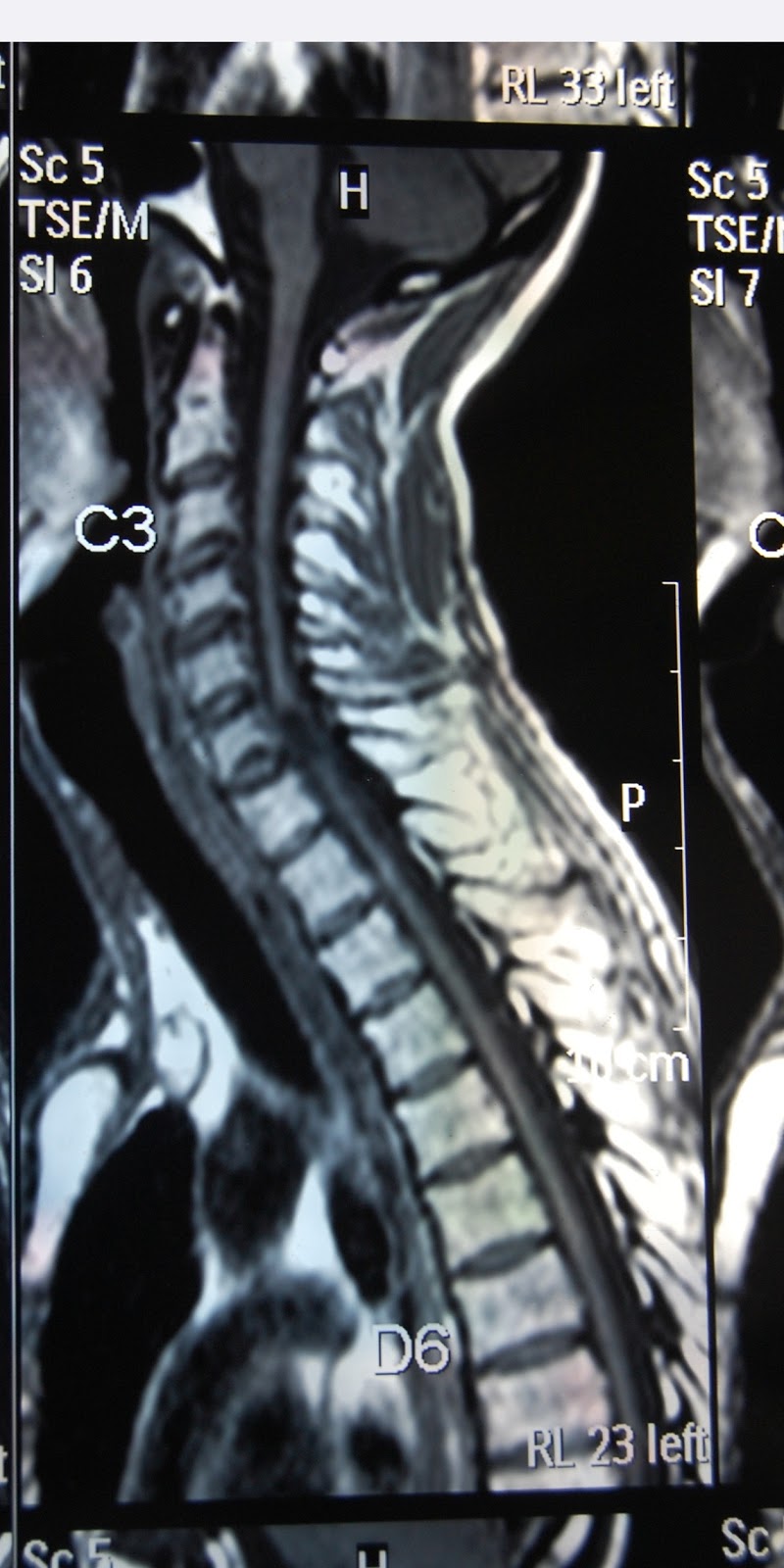 MY Spinal Cord Injury: MY MRI REPORTS