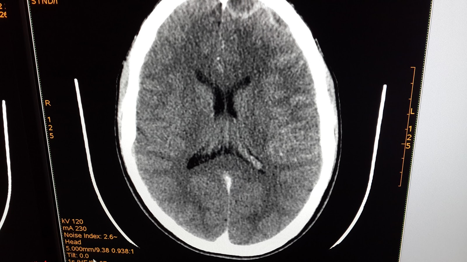 EL RINCON DEL INTERNISTA: Mucocele frontal y absceso epidural ...