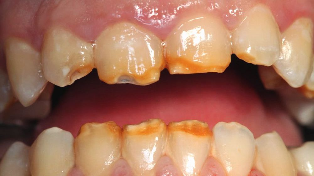 PATOLOGÍA BUCAL : Qué es la Amelogénesis Imperfecta? Tratamiento